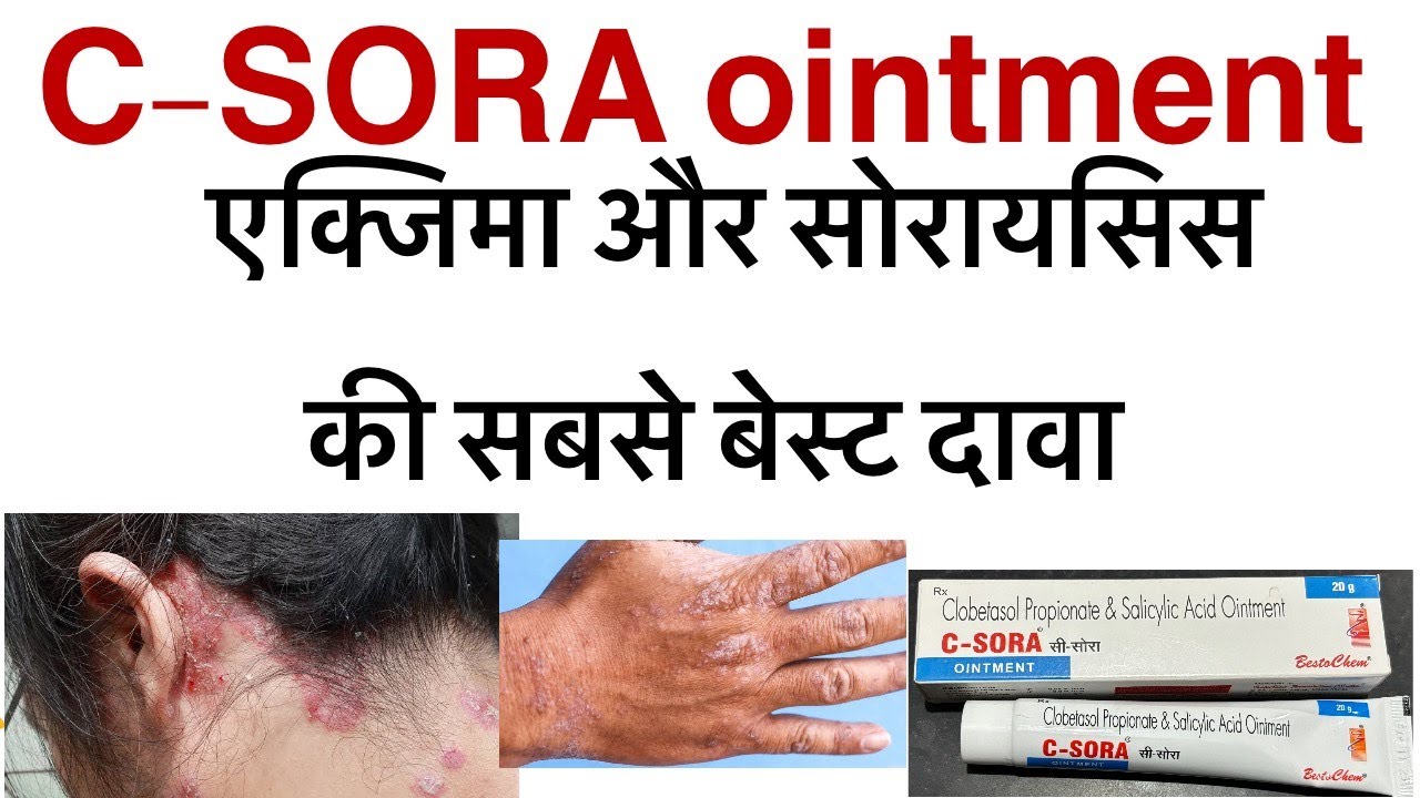 C sora ointment uses in hindi/clobetasol propionate & salicylic acid ...
