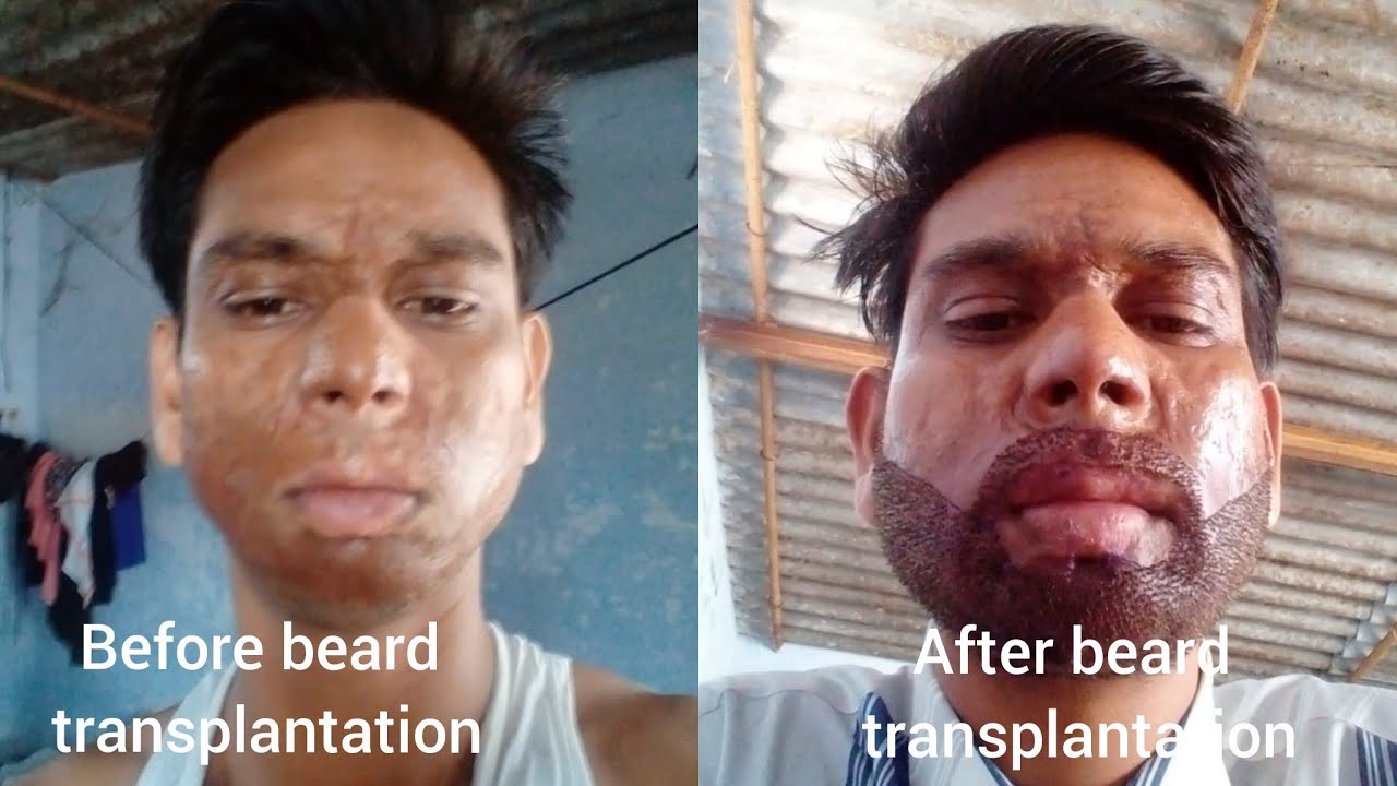 2024 best beard transplantation. சென்னைHair studio clinic .63812555757 ...