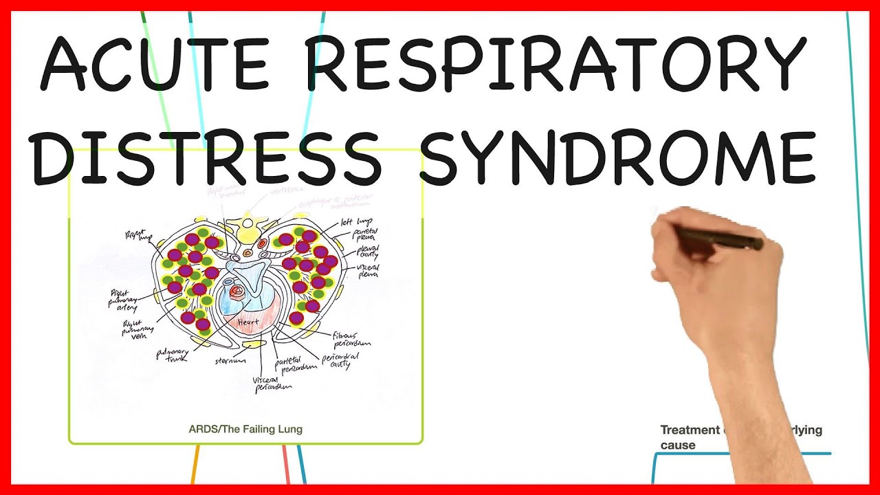 ACUTE RESPIRATORY DISTRESS SYNDROME (ARDS) - PHYSIOLOGY SERIES - YouTube