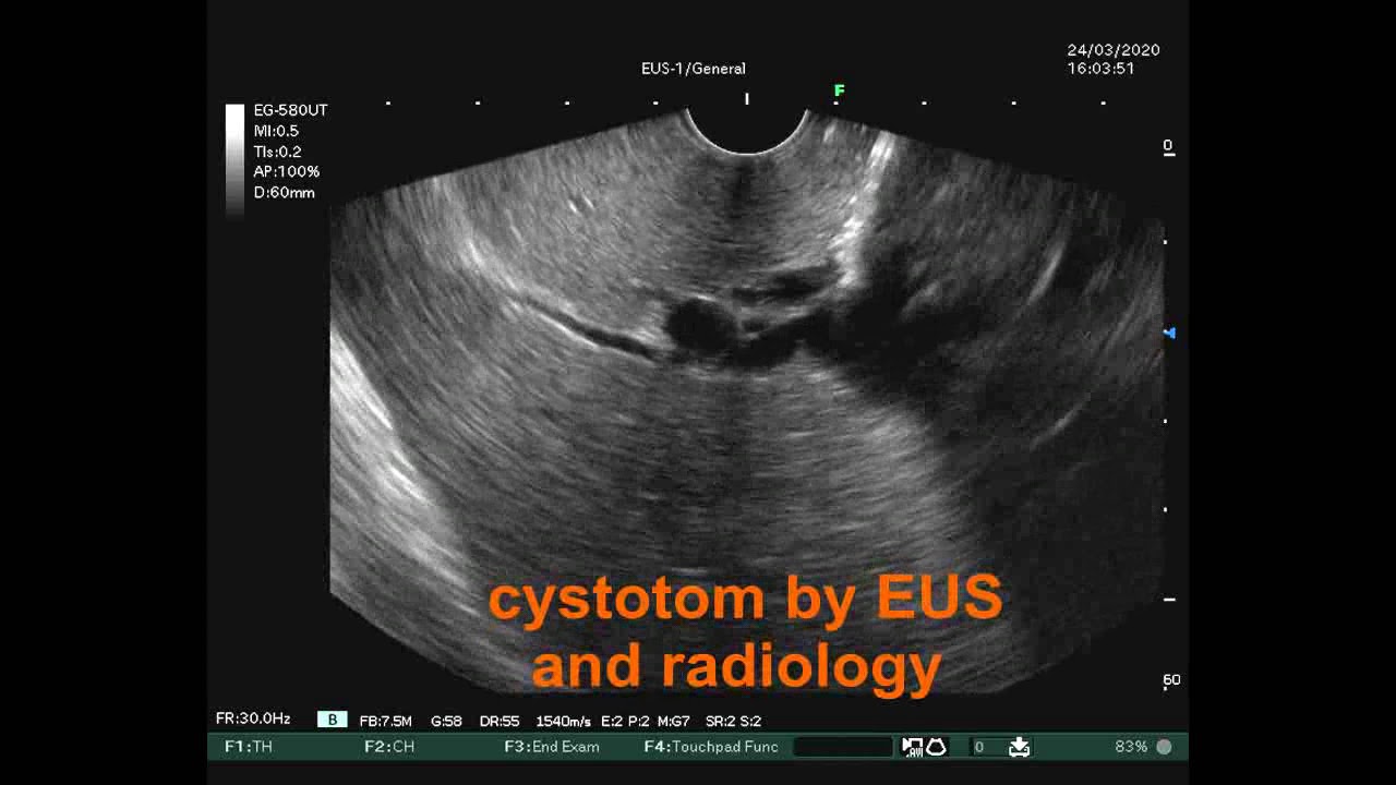 EUS guided HGS tips and tricks(KHALED RAGAB,MD AND ELSAYED GHONYM, MD ...