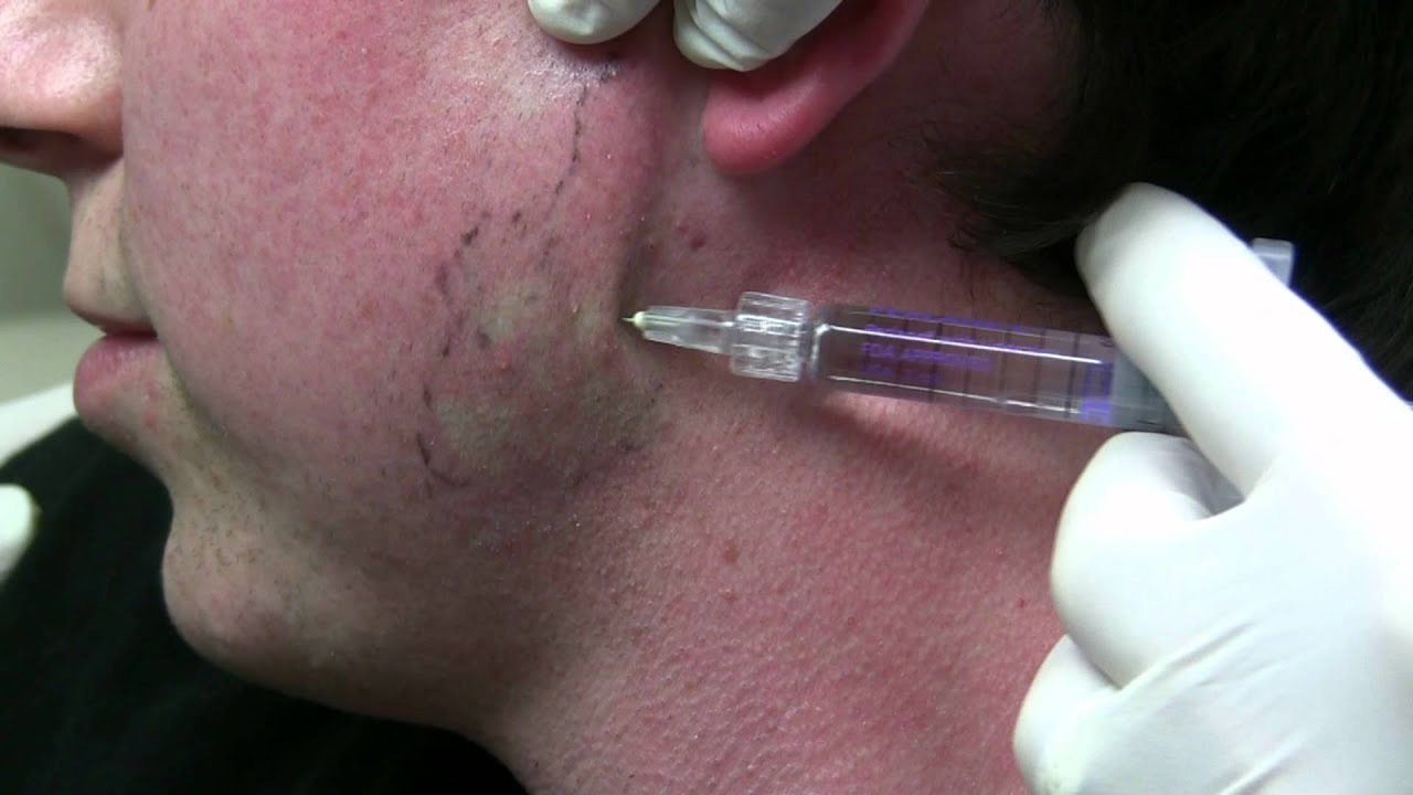 Mandibular Angle Augmentation with Injectable Filler by Dr. Joe Niamtu ...