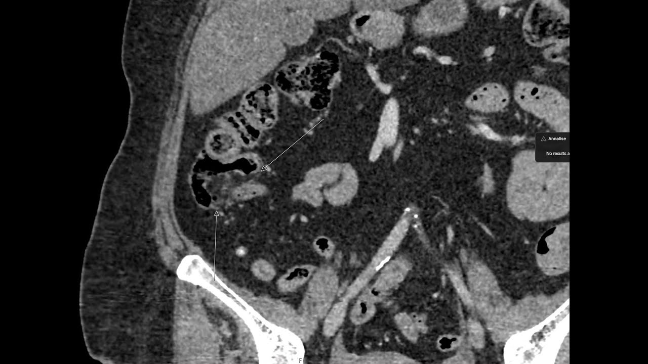Lipomatosis of the ileocecal valve - YouTube