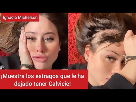 ¡Ignacia Michelson muestra los estragos que le ha dejado tener Calvicie!