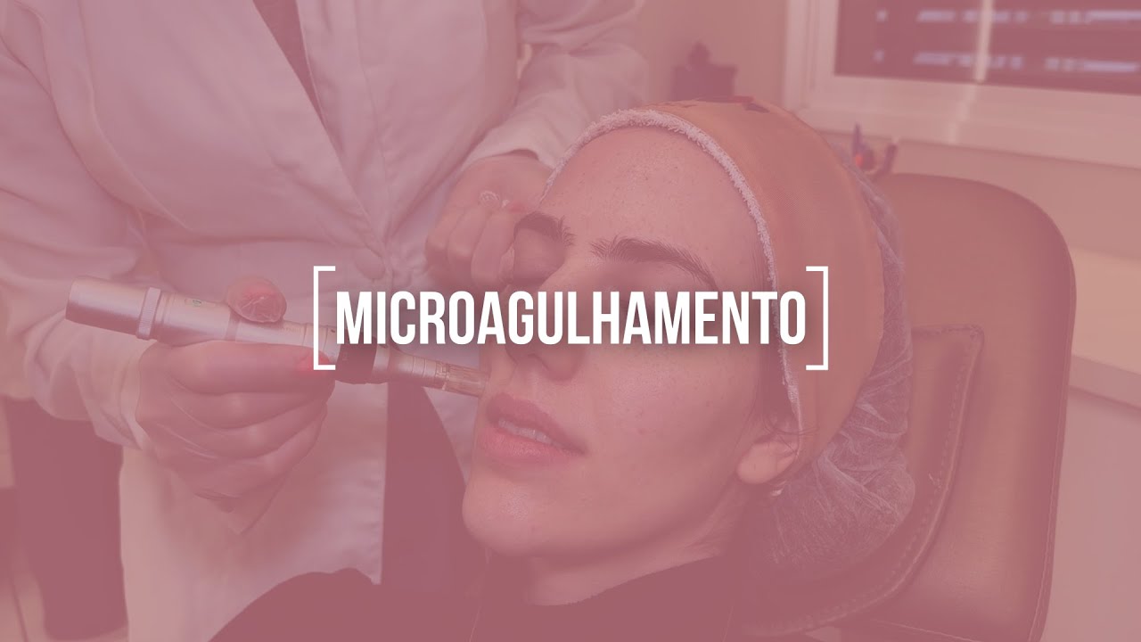 Microagulhamento Capilar e Facial | Indicações e Benefícios | Clínica ...