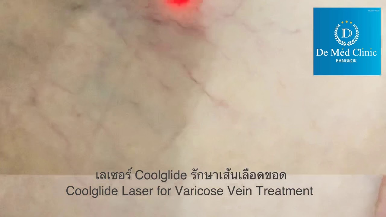 เลเซอร์ Coolglide รักษาเส้นเลือดขอด Coolglide Laser for Varicose Vein ...