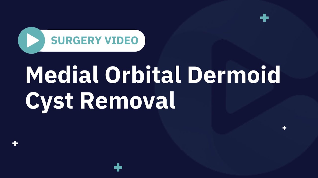Surgery Video: Medial Orbital Dermoid Cyst Removal - YouTube