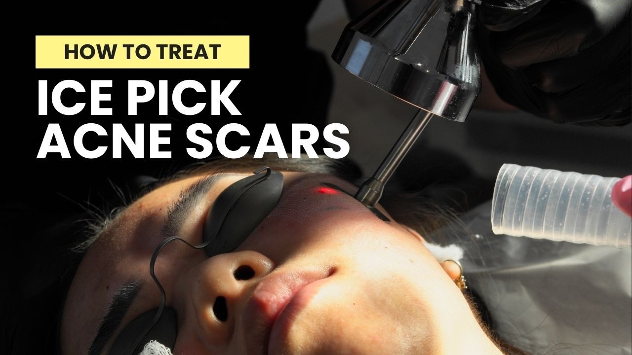 Dr Qazi : How to Treat Ice Pick Acne Scars: TCA Cross, Subcision, CO2 ...