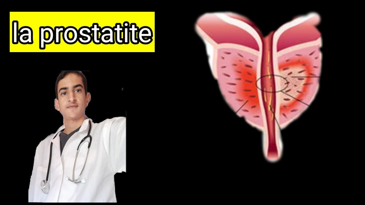 la prostatite - YouTube