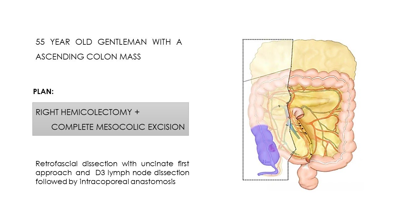 Robotic Right Hemicolectomy + D3 Lymph node dissection + Intracorporeal ...