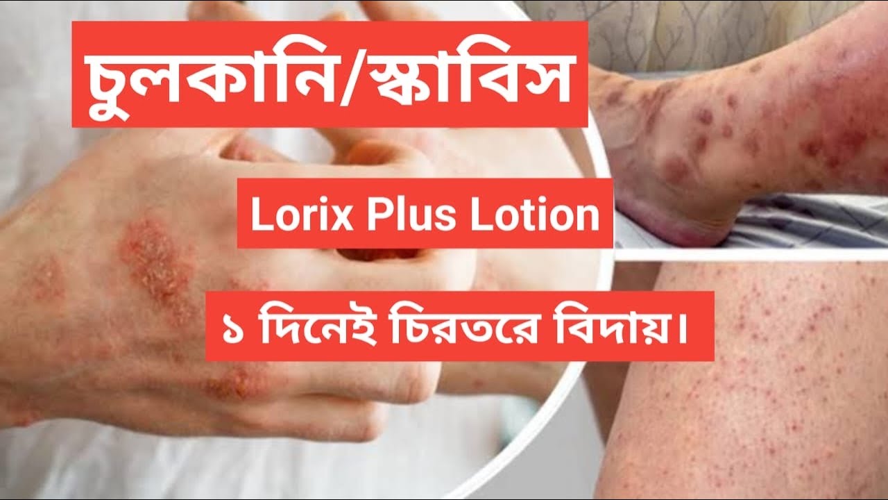 Lorix plus lotion | pharmacist Siddik| Drug Review | Medicine Review ...