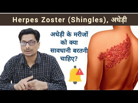 Herpes Zoster (Shingles), अधेड़ी | अधेड़ी के मरीजों को क्या सावधानी बरतनी चाहिए? chicken pox #herpes