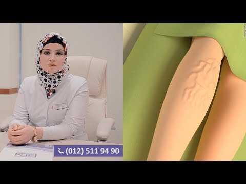 Tromblar necə yaranır və niyə təhlükəlidir? - Həkim XƏBƏRDARLIĞI