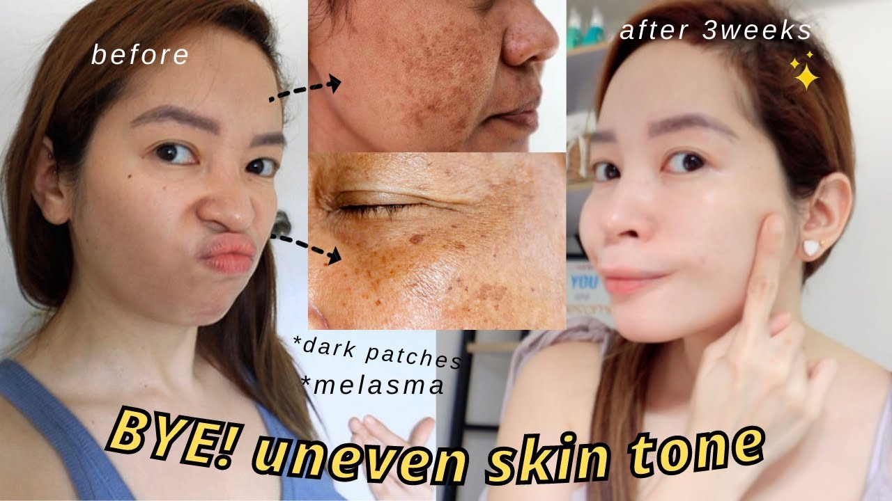 MELASMA, Dark Patches, Uneven Skin Tone! PANO MAWALA 'SKIN1004 3Weeks ...