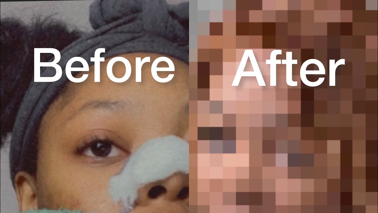 Day 14 after my nose job | *nose job reveal* is it a huge fail? - YouTube