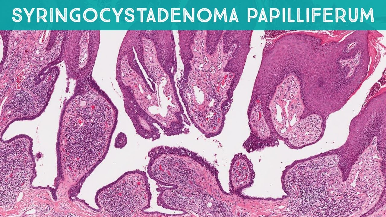 Syringocystadenoma Papilliferum (SCAP): Dermpath in 5 Minutes ...