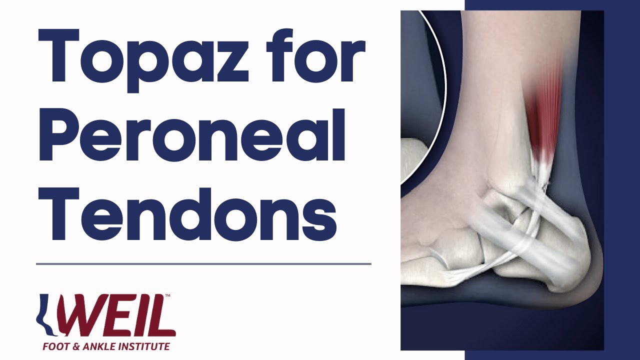 Topaz for Peroneal Tendons | Weil Foot & Ankle Institute - YouTube