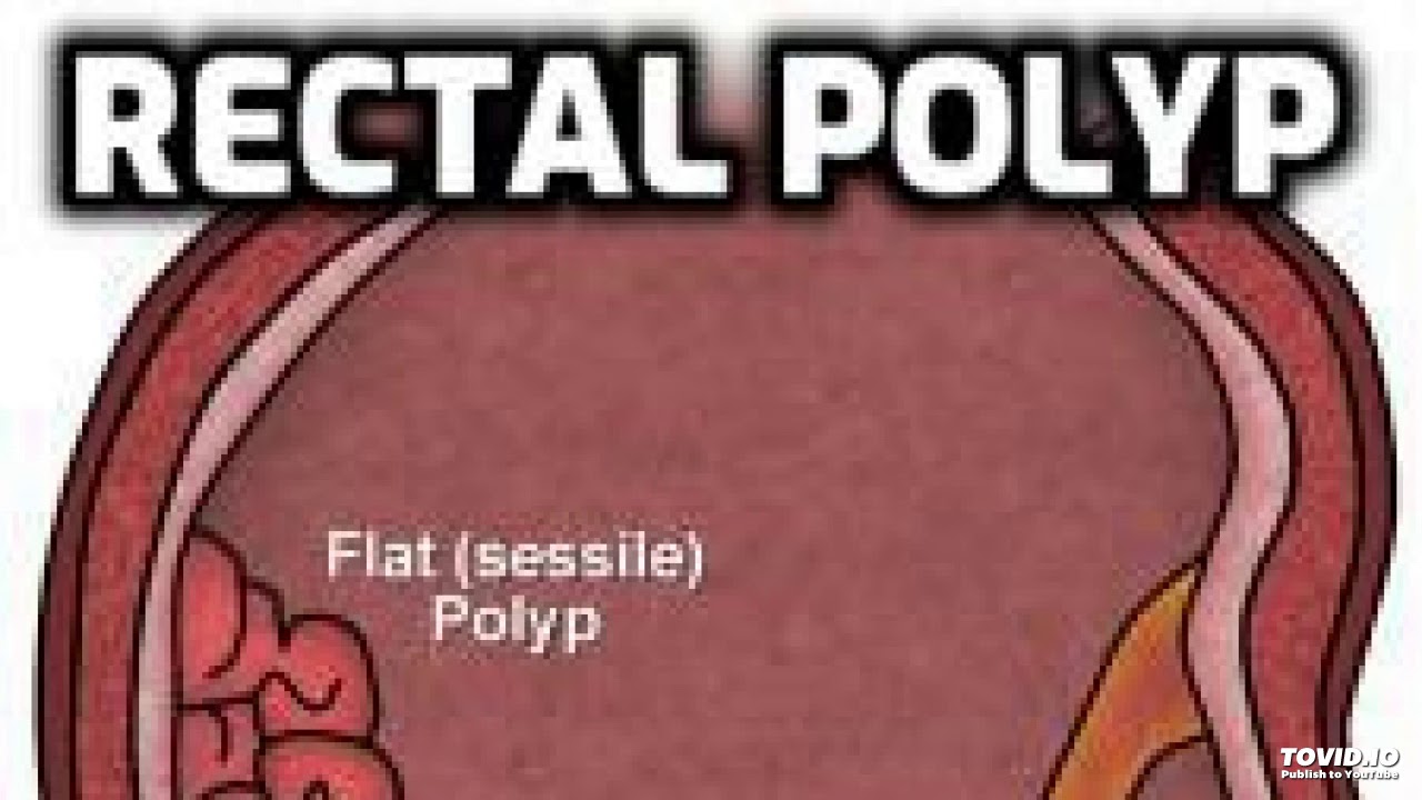 Rectal Polyp - YouTube