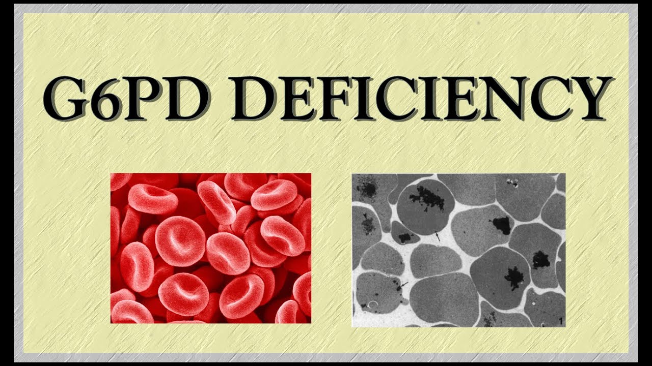 G6PD deficiency | BIO CHEMISTRY |METABOLISM | ANYTIME MEDICINE - YouTube