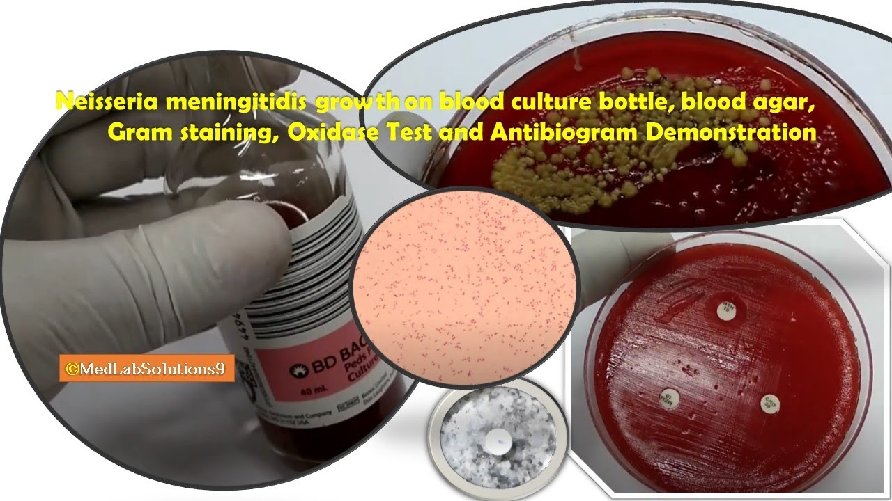Neisseria meningitidis growth on blood culture bottle, blood agar ...