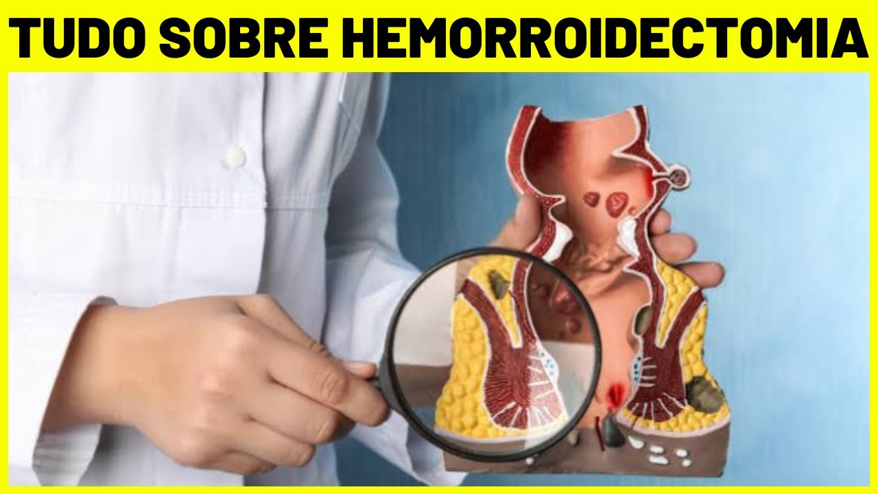 O que é HEMORROIDECTOMIA? Para que serve e como é feito? - YouTube