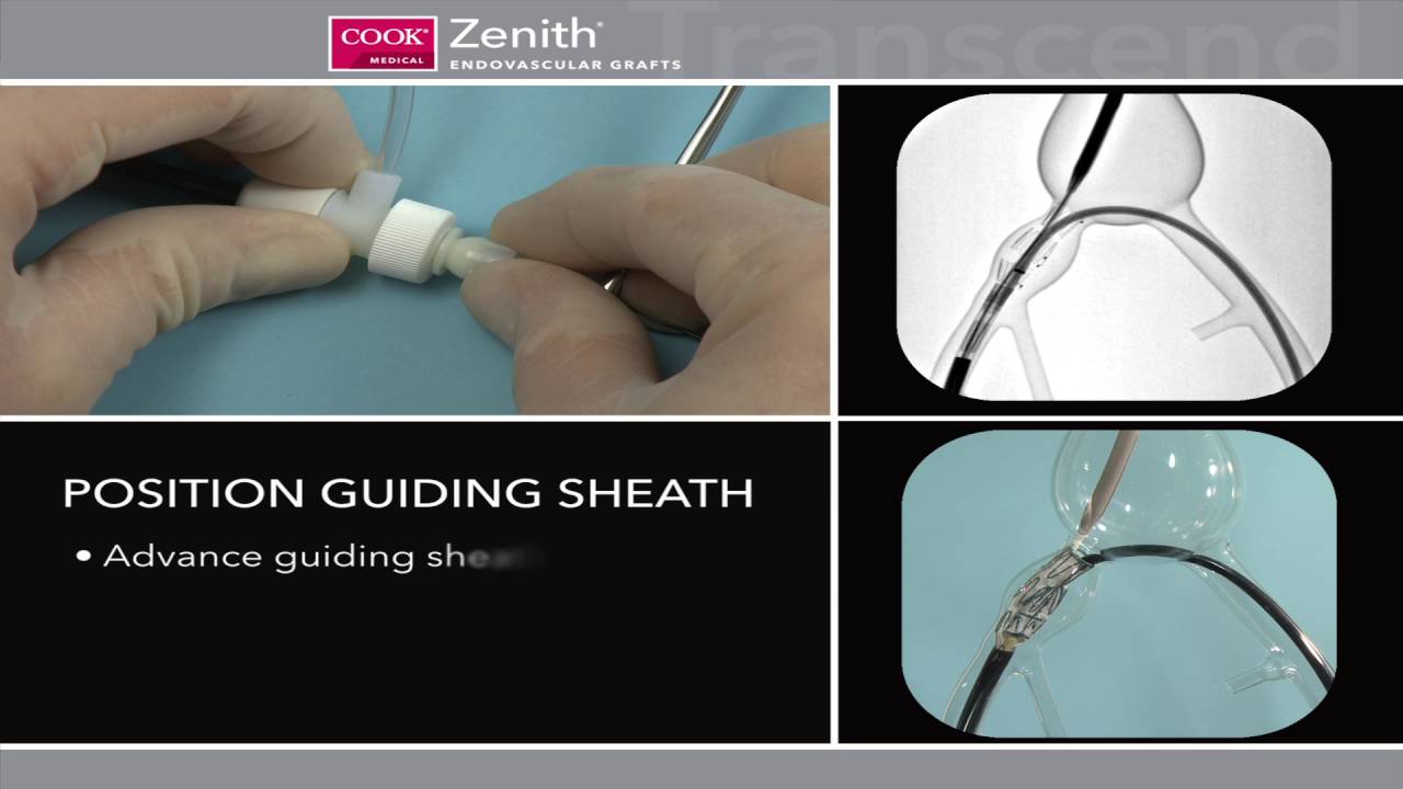 Iliac Branched device (IBD) - YouTube