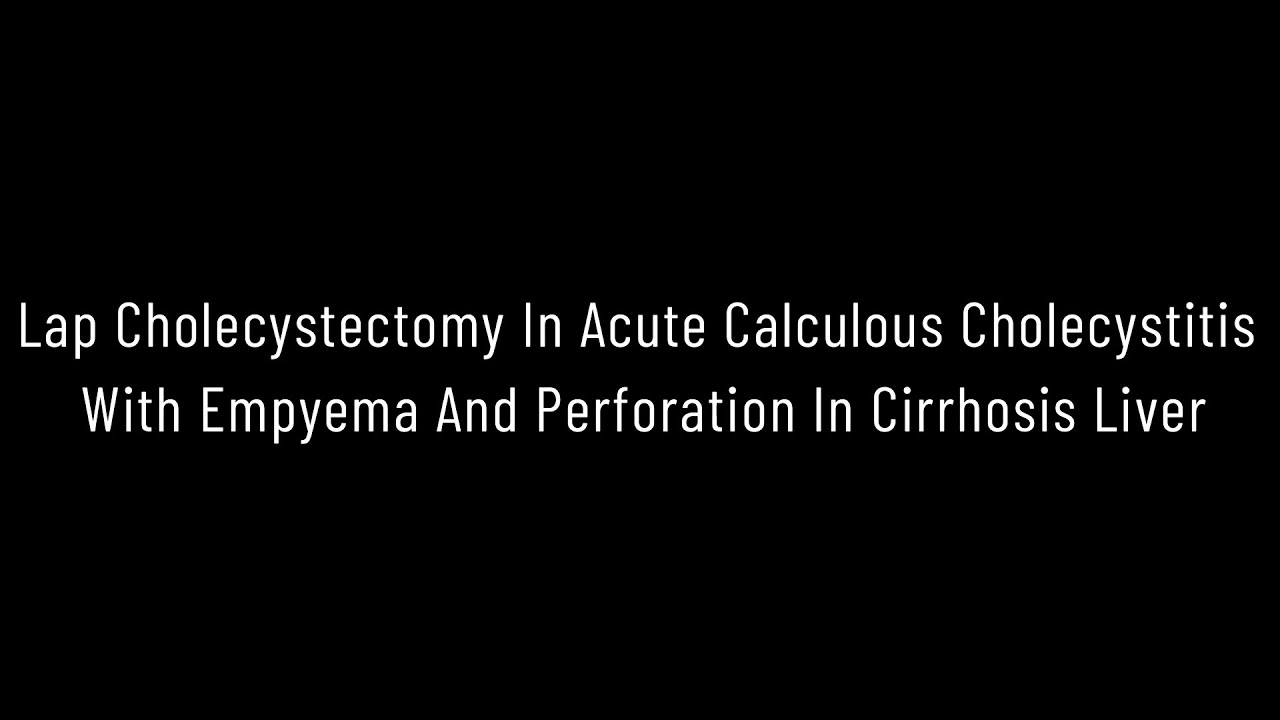 Lap Cholecystectomy in acute Calculous Cholecystitis perforation in ...