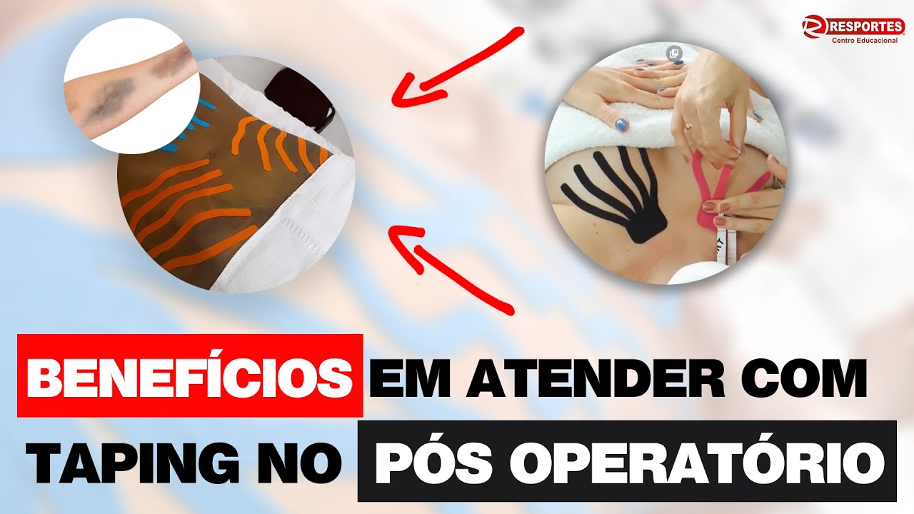 5 motivos para aplicar o TAPING no PÓS OPERATÓRIO! - YouTube