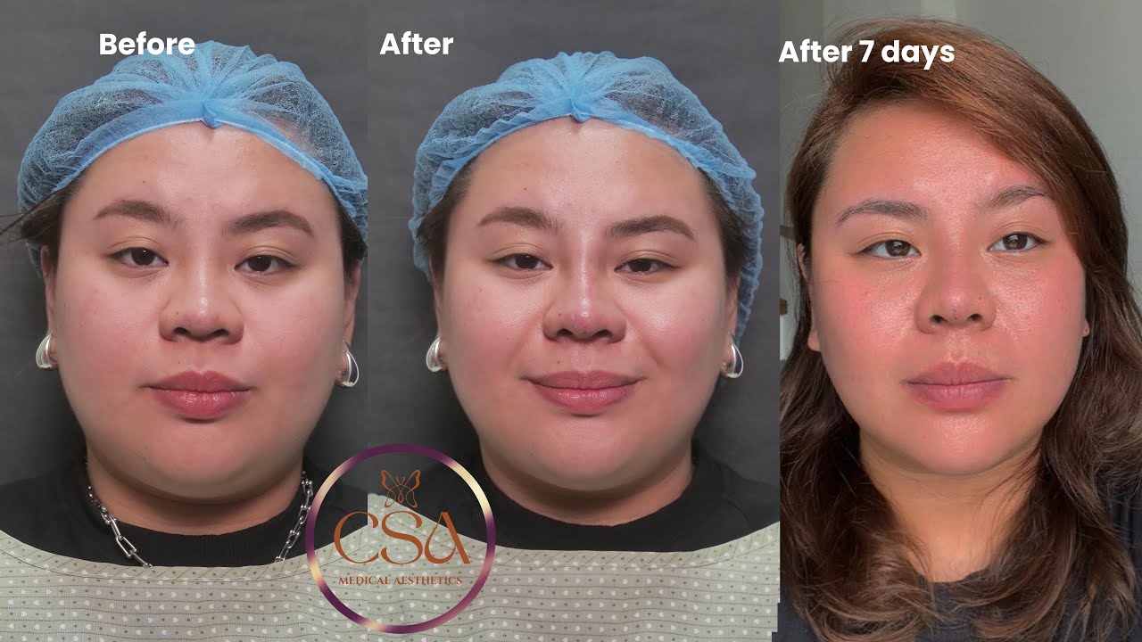 Nose Tweakment with Filler, PDO threads , Botox and fat dissolve - YouTube