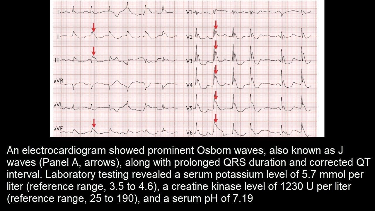 Hypothermie EKG J Wave bzw Osborne Wave - YouTube