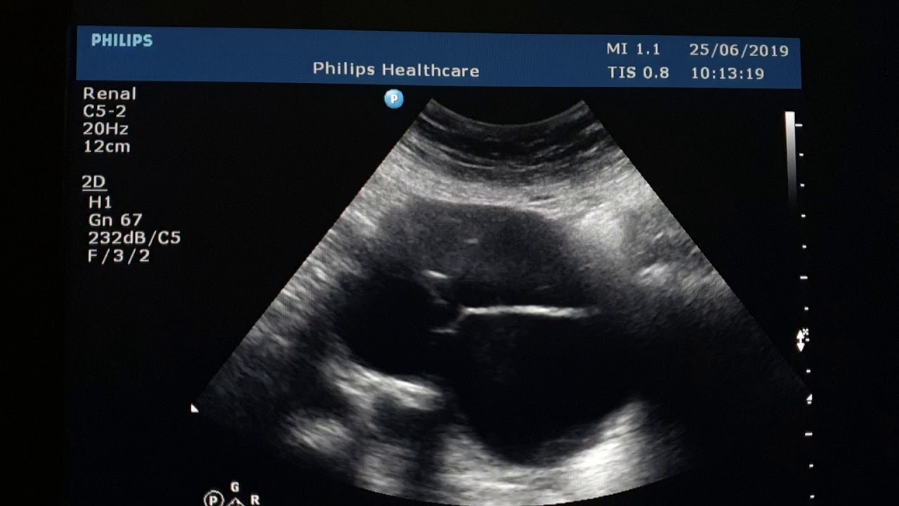 Ovarian Hyperstimulation Syndrome OHSS - YouTube