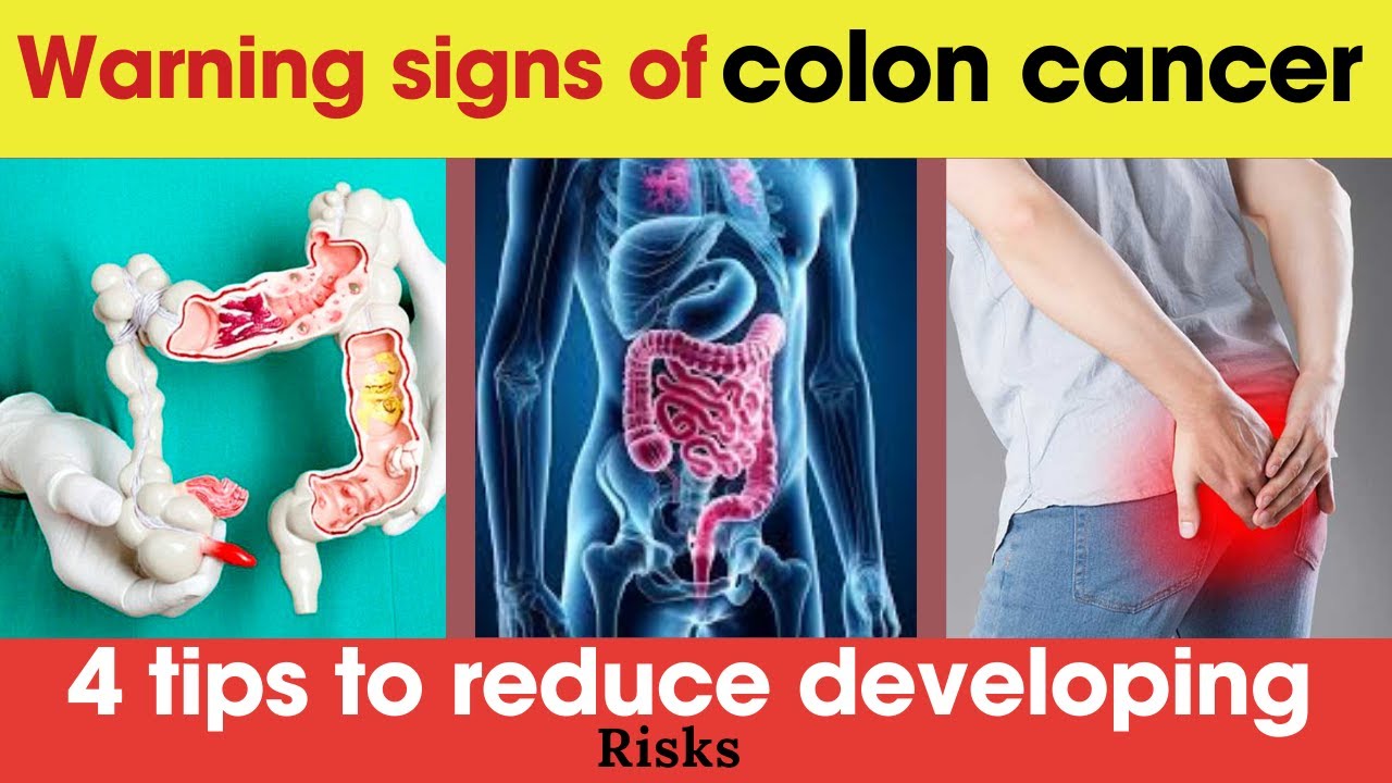 Colon Cancer: Warning Signs & Risk Reduction Tips | medvista - YouTube