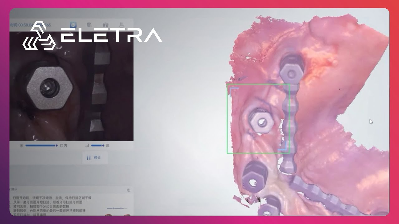 ELETRA SMART Scanner in Action - Single-Arch lmplant - YouTube