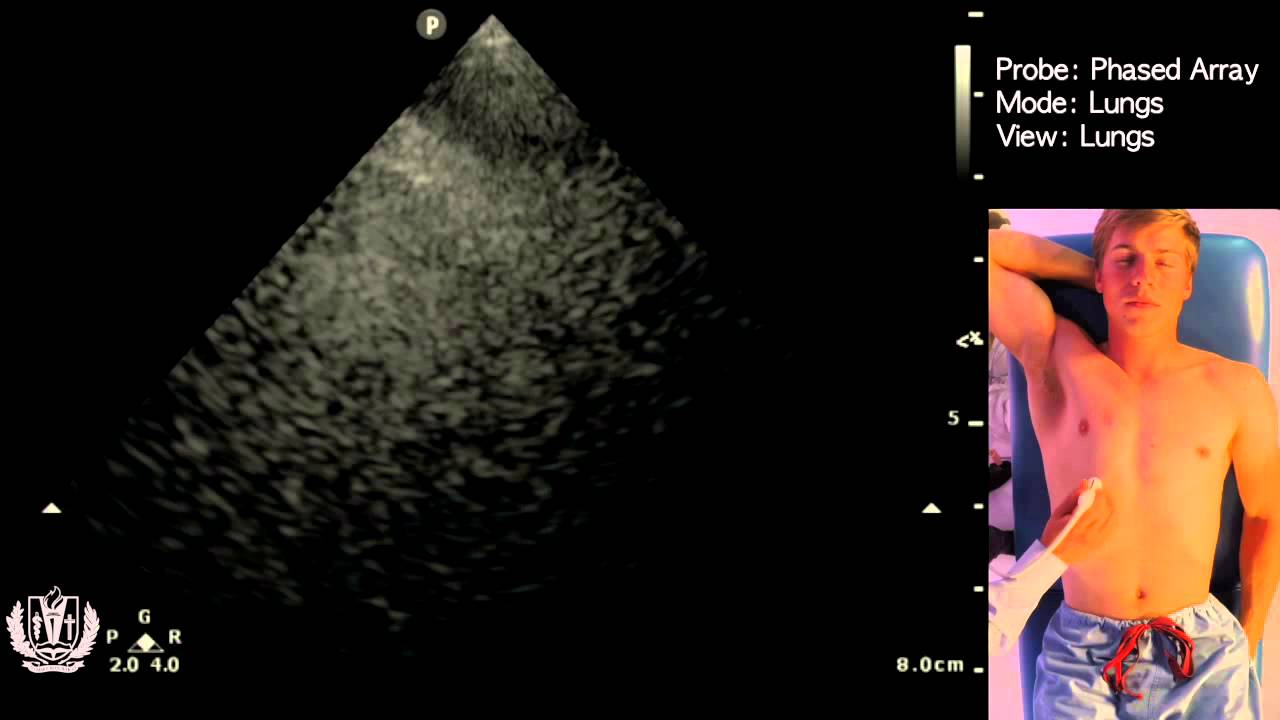 Evaluating the Lungs using Ultrasound - YouTube
