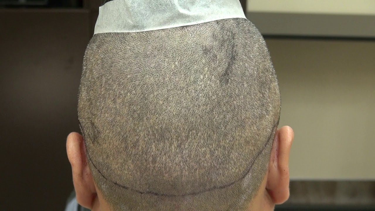 FUE Donor Scar After 10 Year Post Op Dr. Diep http://www.mhtaclinic.com ...