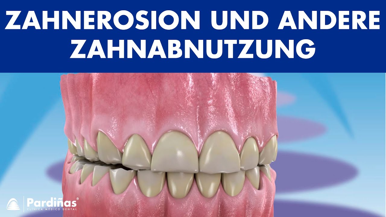 Zahnerosion, Abrasion, Wurzelresorption und andere Zahnabnutzung ...
