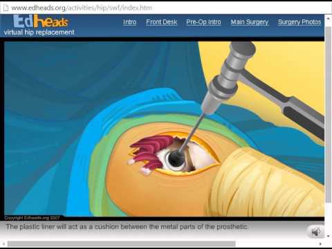 Virtual Hip Replacement Games For Girls : Free Programs, Utilities and ...