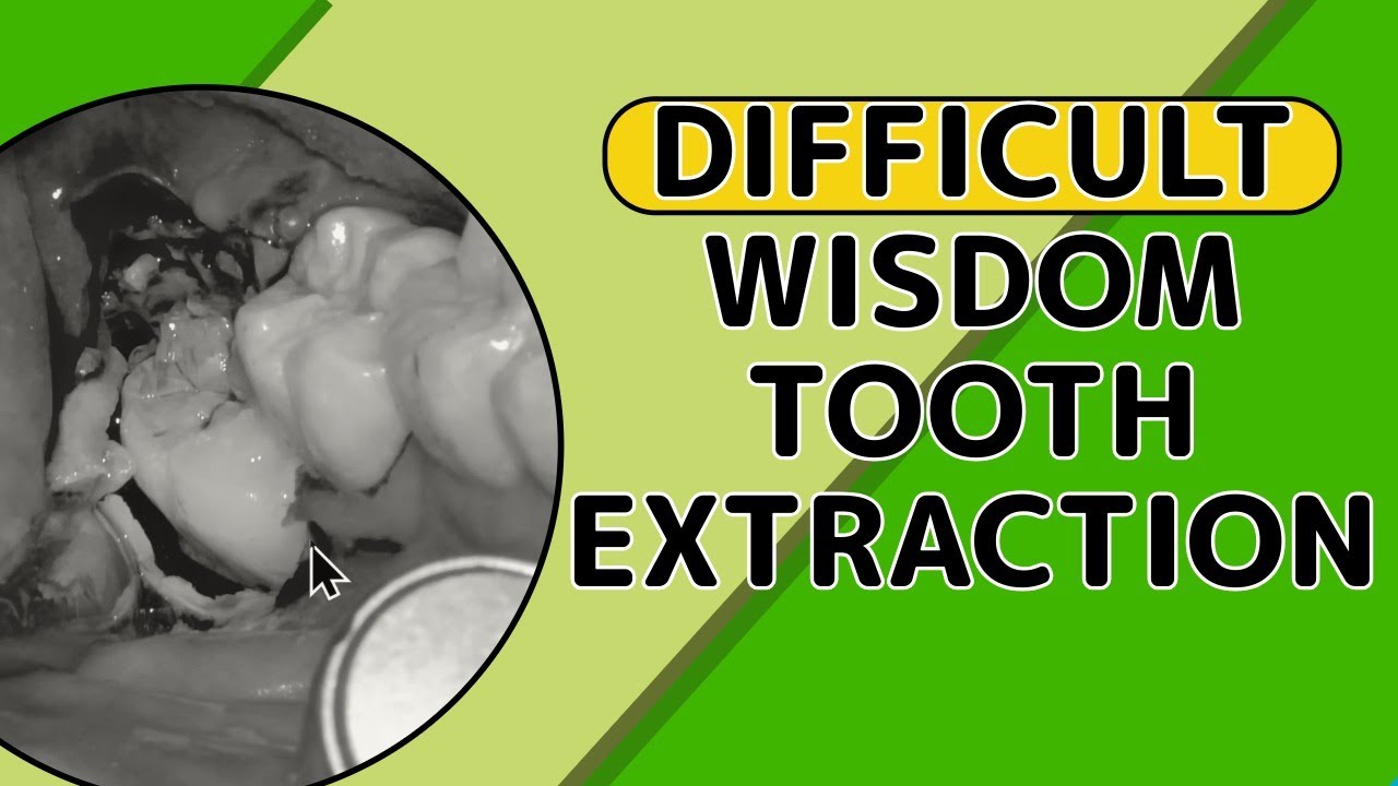 [99] Difficult Wisdom Tooth Extraction - YouTube