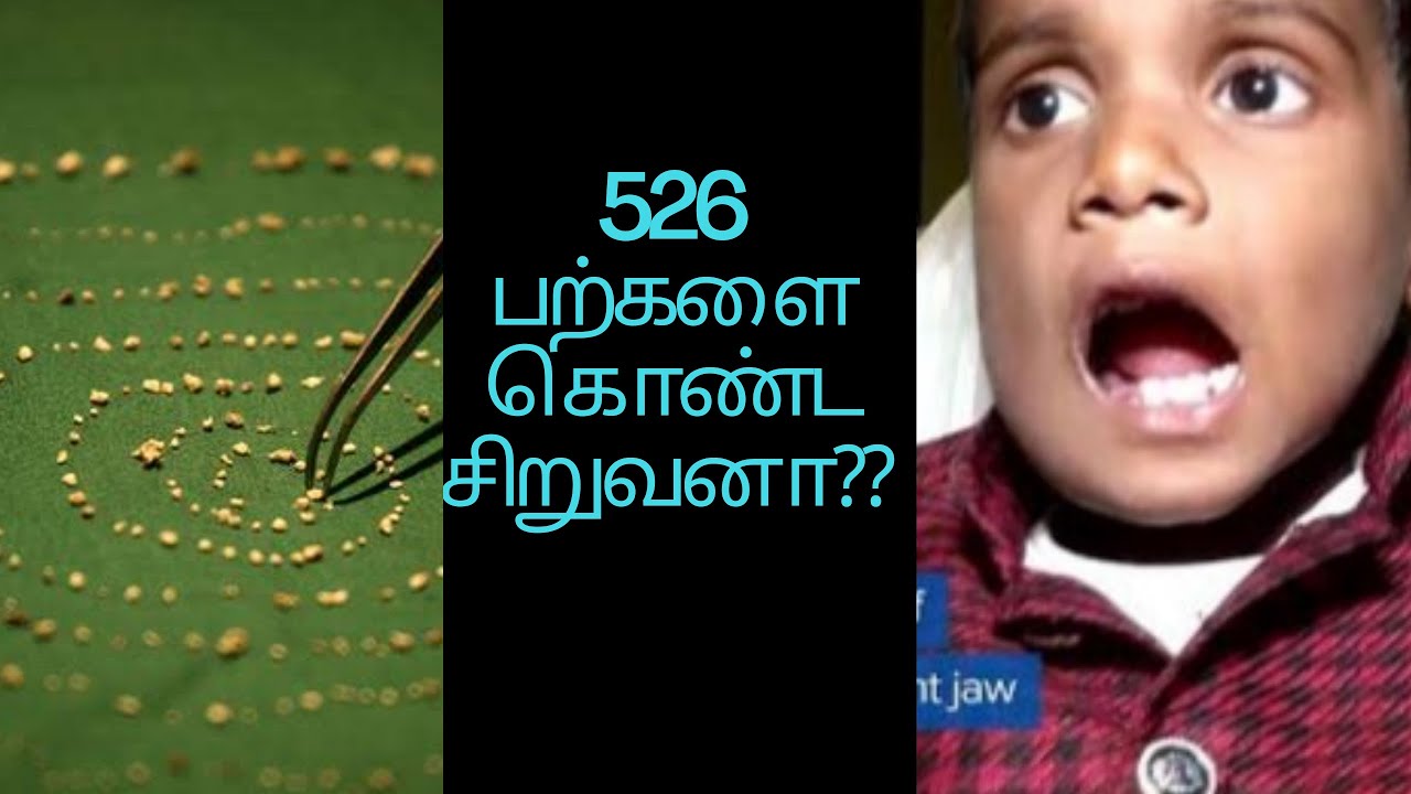 526 Teeth removed from mouth💢526 Teeth boy💢Compound odontoma💢526 Teeth ...