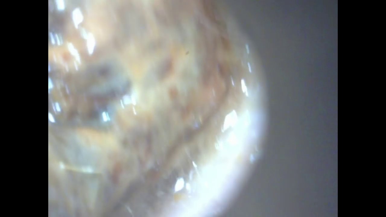 Ear Wax Removal one huge plug from a surfer ASMR - YouTube