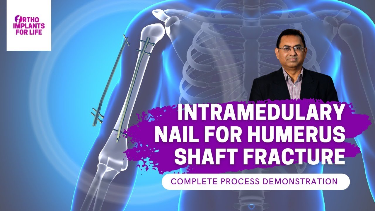 Intramedullary Nail For Humerus Shaft Fracture Procedure - YouTube