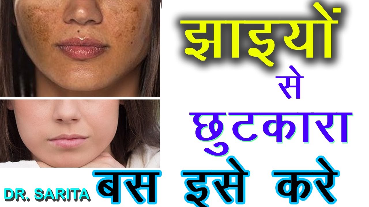 Body Me White Daag Kaise Hataye at Zane Murray-prior blog