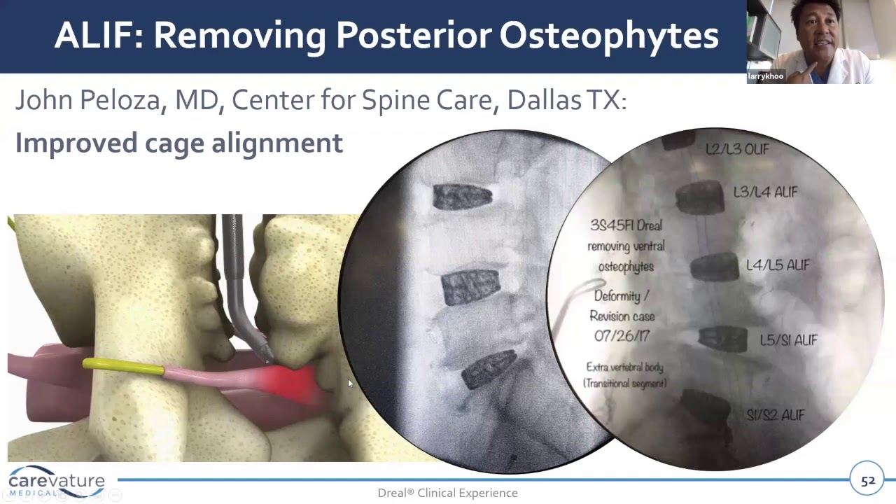 Larry Khoo, MD - ALIF Case Review - YouTube