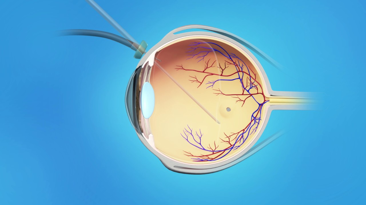 Retina Macular Hole Surgery - YouTube