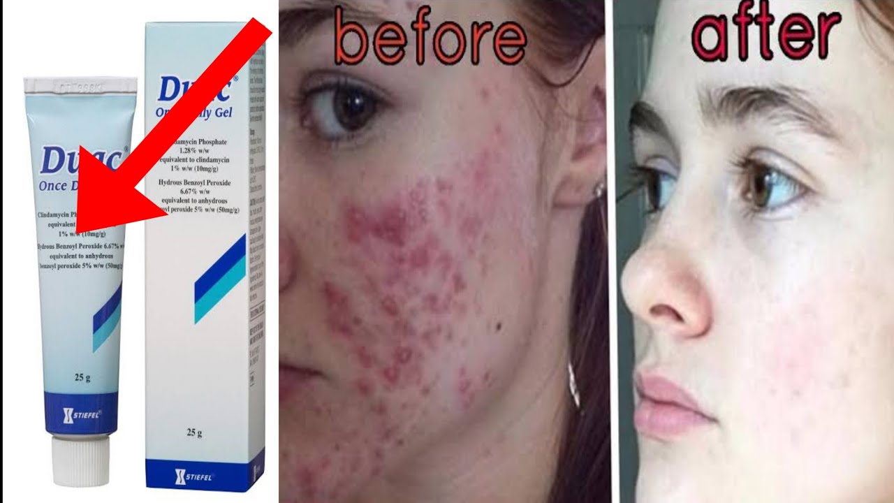 Best Gel For Acne In Pakistan || Duac Gel Review In Urdu/Hindi || No.1 ...