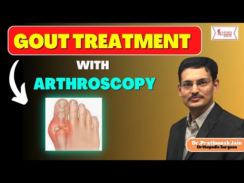Gout of Great Toe : Treatment with Arthroscopy . First MTP joint ...