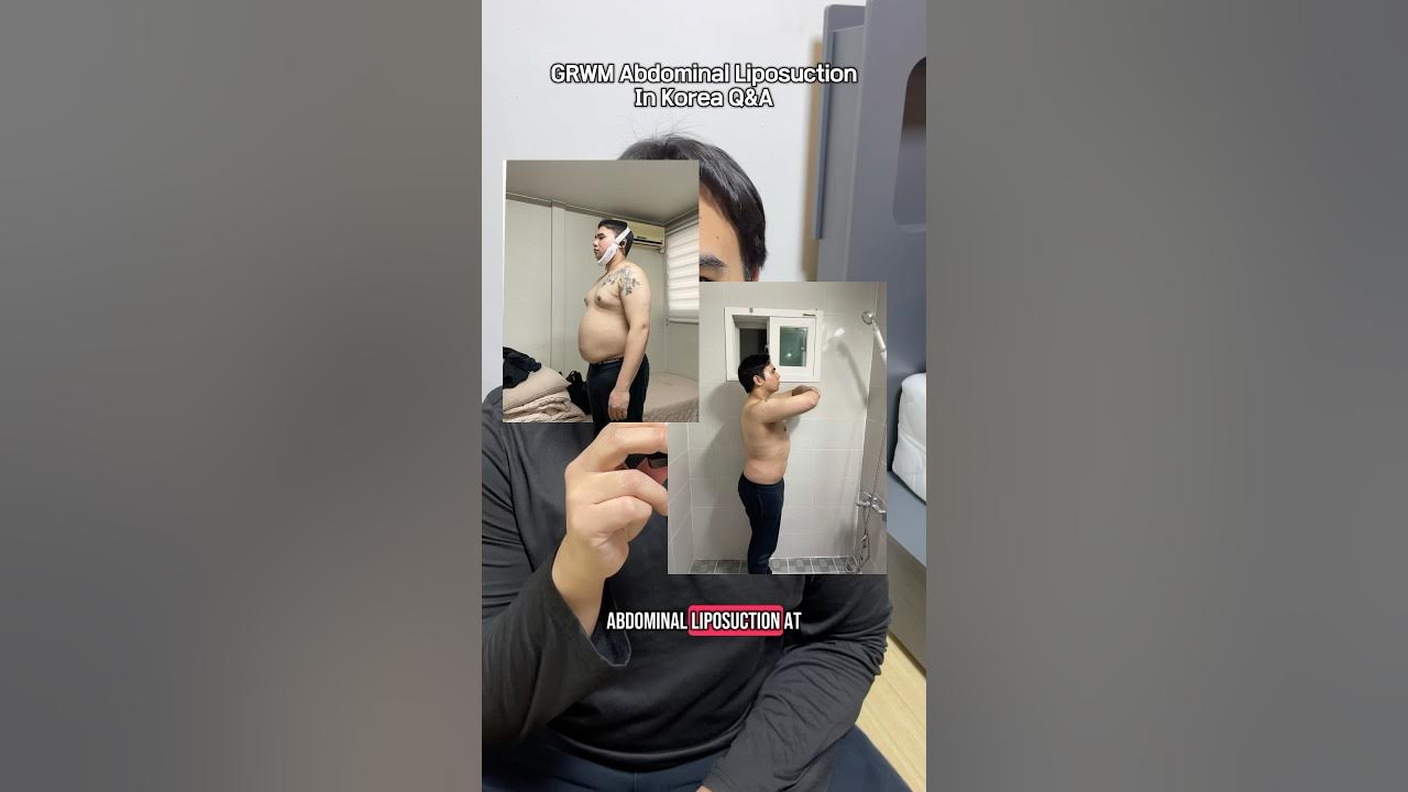 Abdominal Liposuction at @365mc in Seoul Q&A #lams #liposuction - YouTube