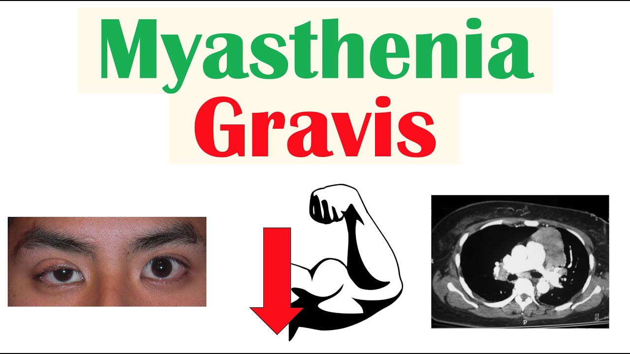 Myasthenia Gravis | Pathophysiology, Signs & Symptoms, Diagnosis ...
