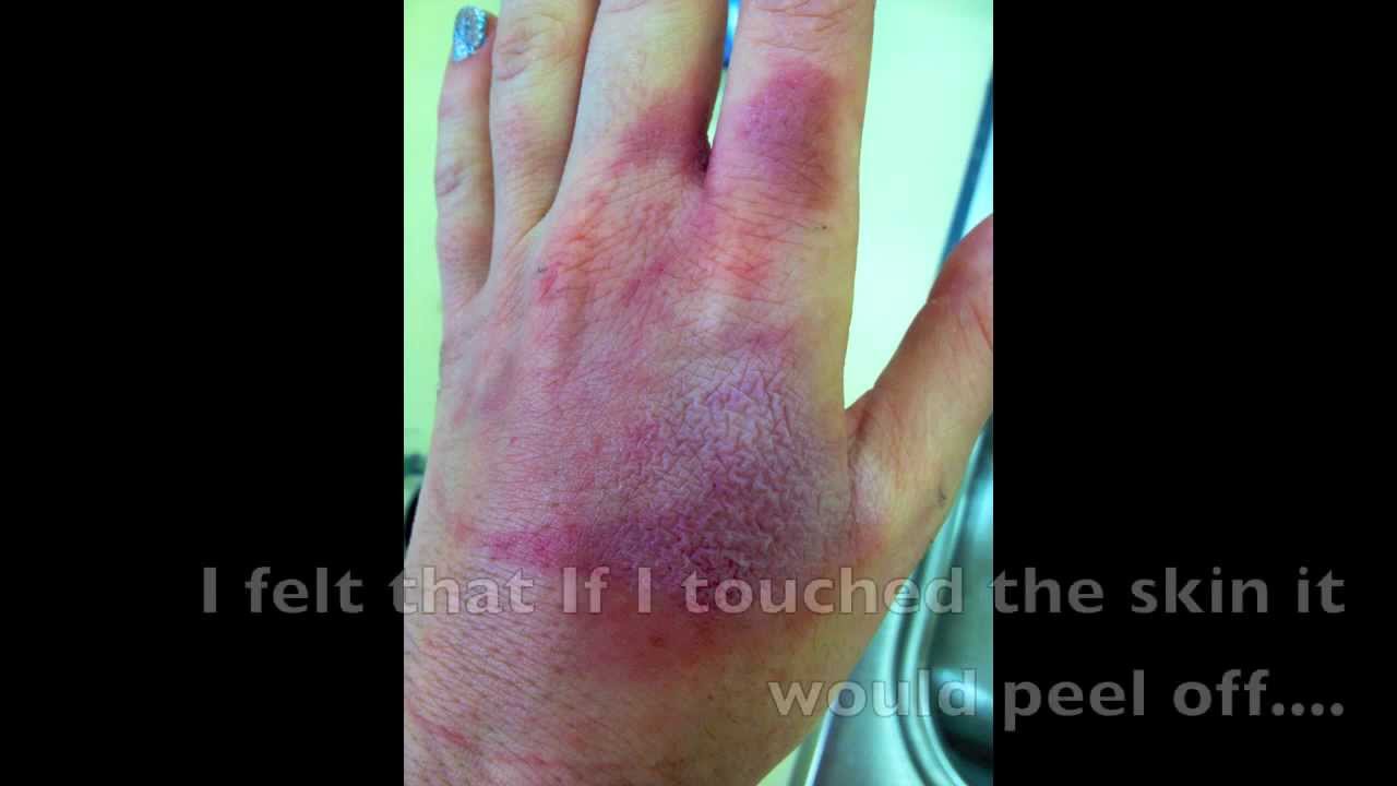 OUCH-I Burnt My Hand! - YouTube