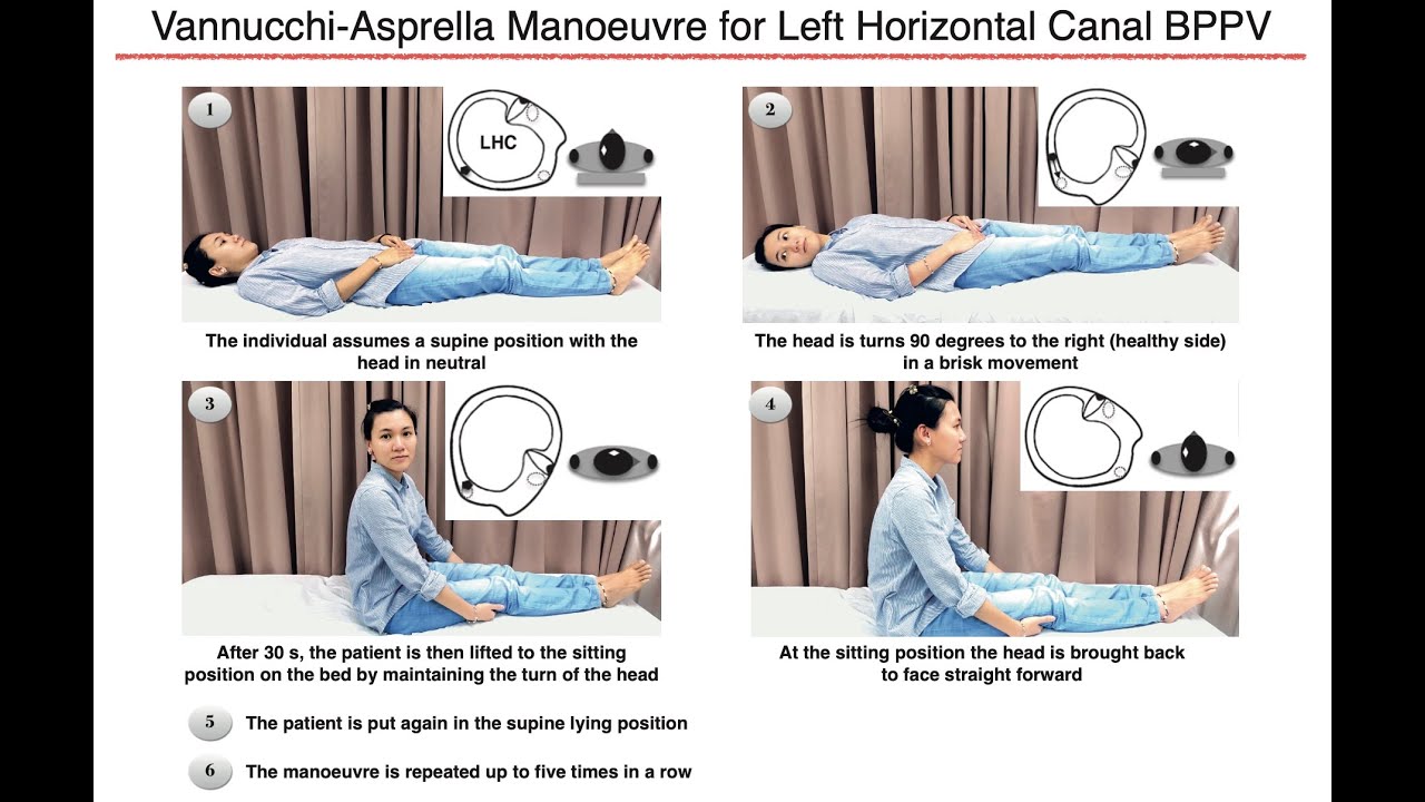 Vannucchi-Asprella Manoeuvre for Left Geotropic Horizontal Canal BPPV ...