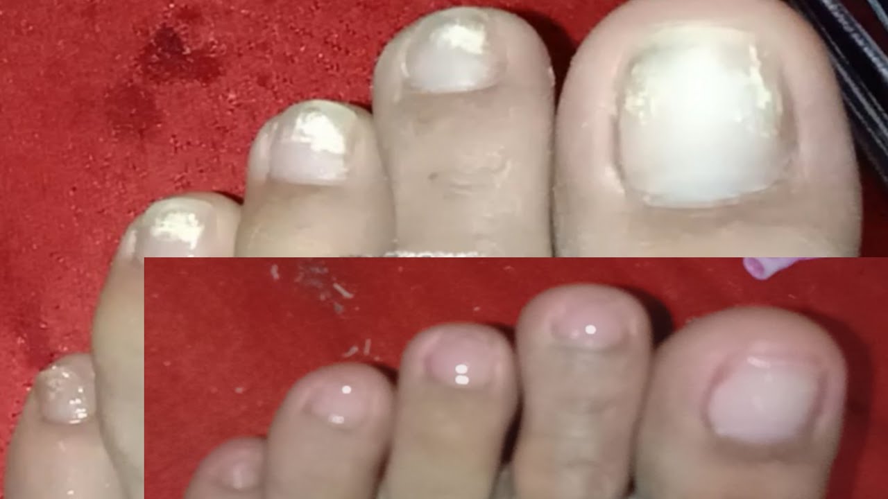 CLIENT112 CLEANING PEDICURE /SATISFYING @chechelegario6373 - YouTube